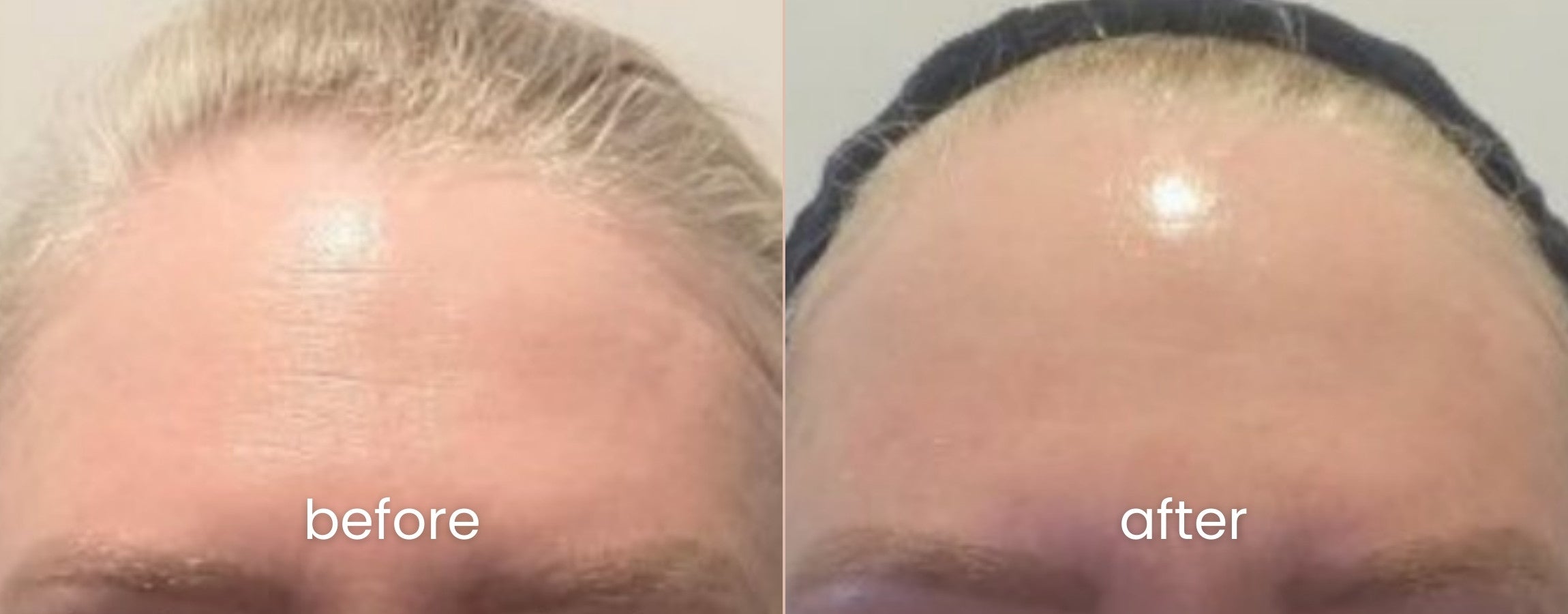 HiFu - non surgical facelift